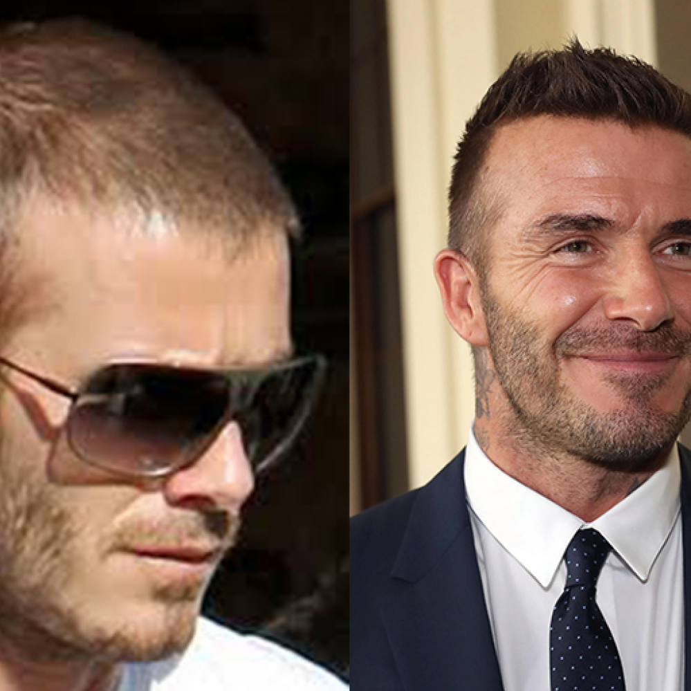 Video: Did David Beckham Have a Hair Transplant? | Restoration Example